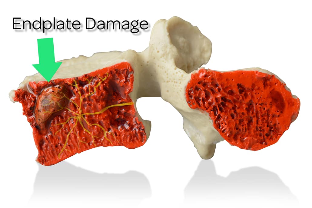 Basivertebral Nerve Ablation - Dynamic Disc Designs