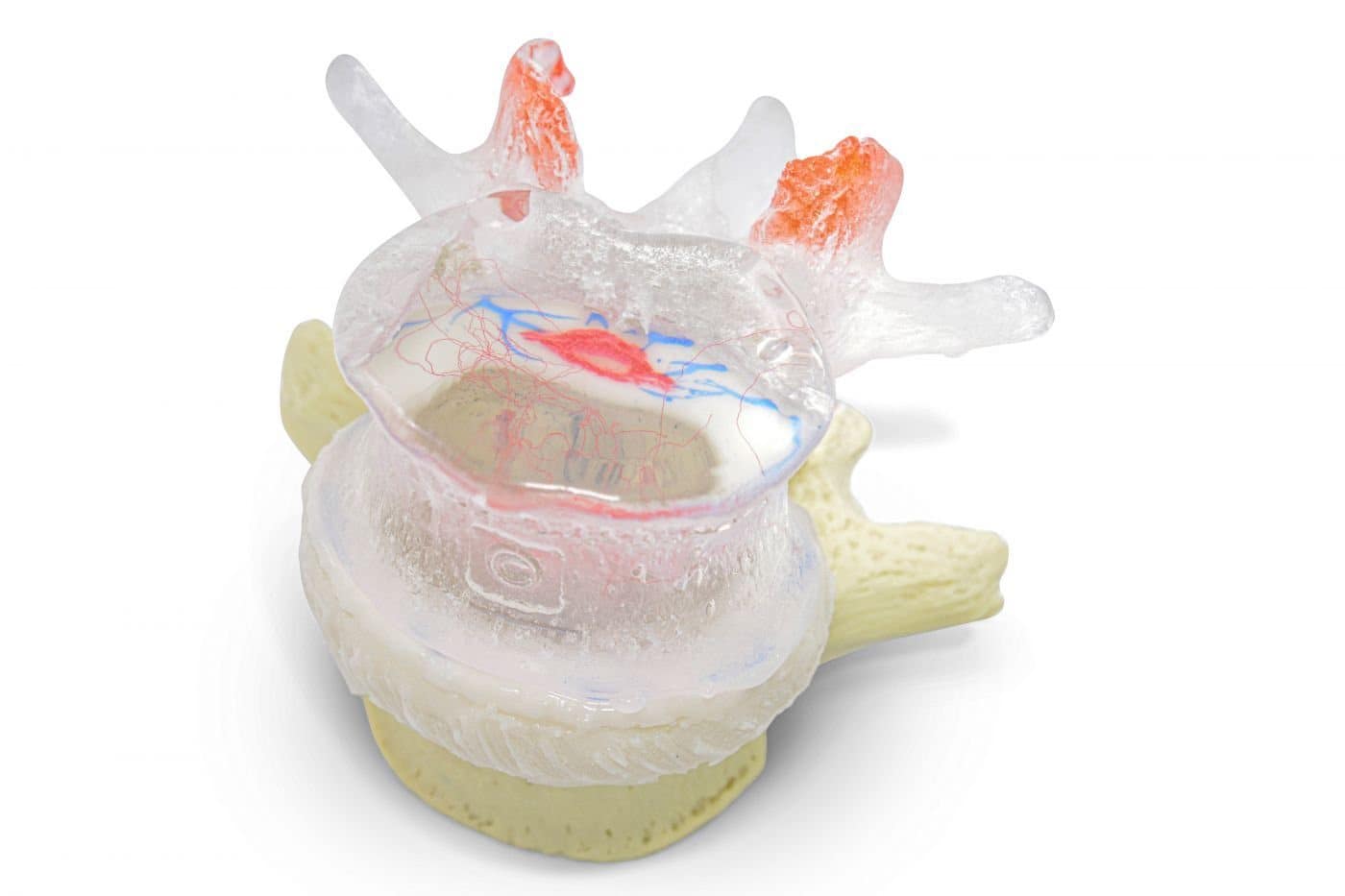 Delamination Lumbar Spine Model - Dynamic Disc Designs