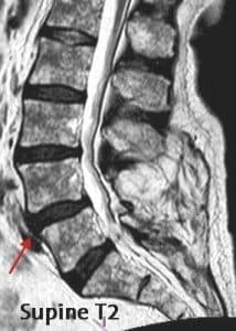 Comparing supine to upright MRI imaging - Case study