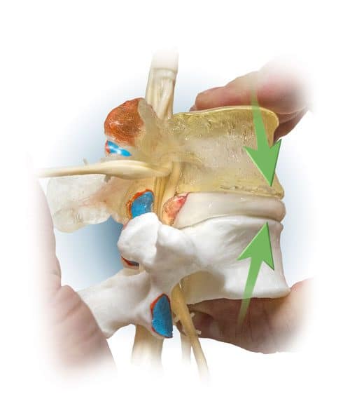 Lumbar Disc Herniation and Resorption – What does the literature say ...