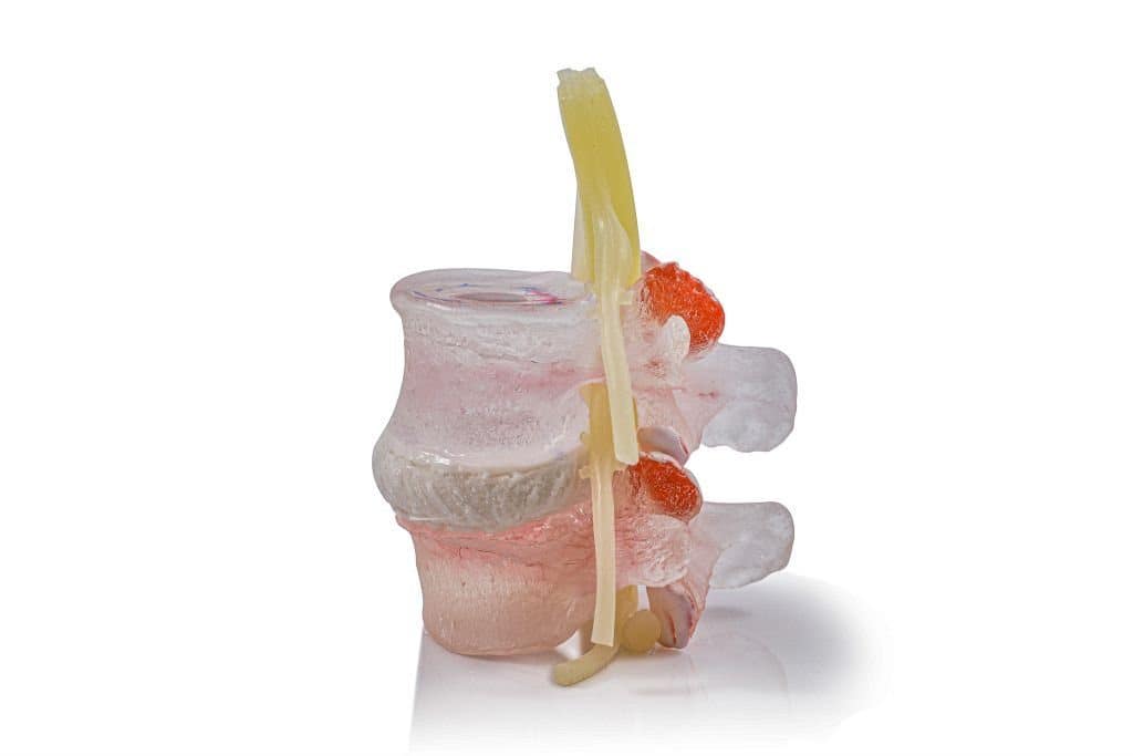 Fully Clear Herniated Dynamic Disc Model - Dynamic Disc Designs