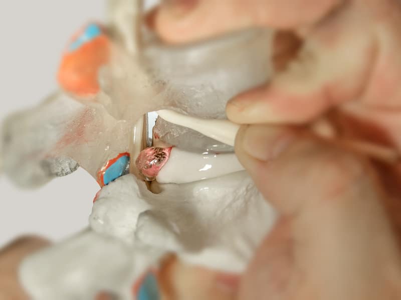 Herniated Disc Model For Patient Education - DDD