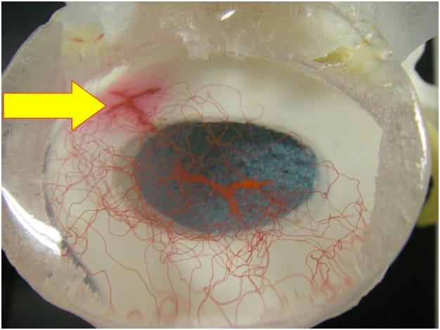 Posterior Annulus and the High Intensity Zone - Research looks to sub ...